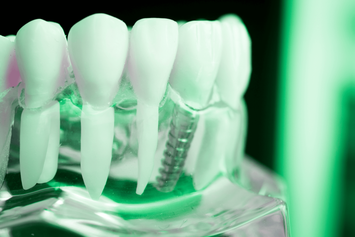 Navigierte Implantologie - Zahnarzt in Bergheim Quadrat Zahnärzte in ...